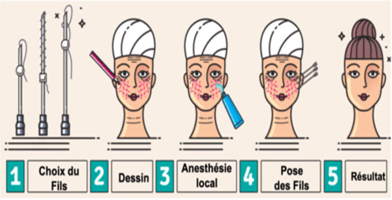 Le lifting frontal avec fils tenseurs permanents est-il utilisé en ...